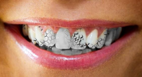 Muela muy rota a nivel de la encía | Guia Dental Mexicali